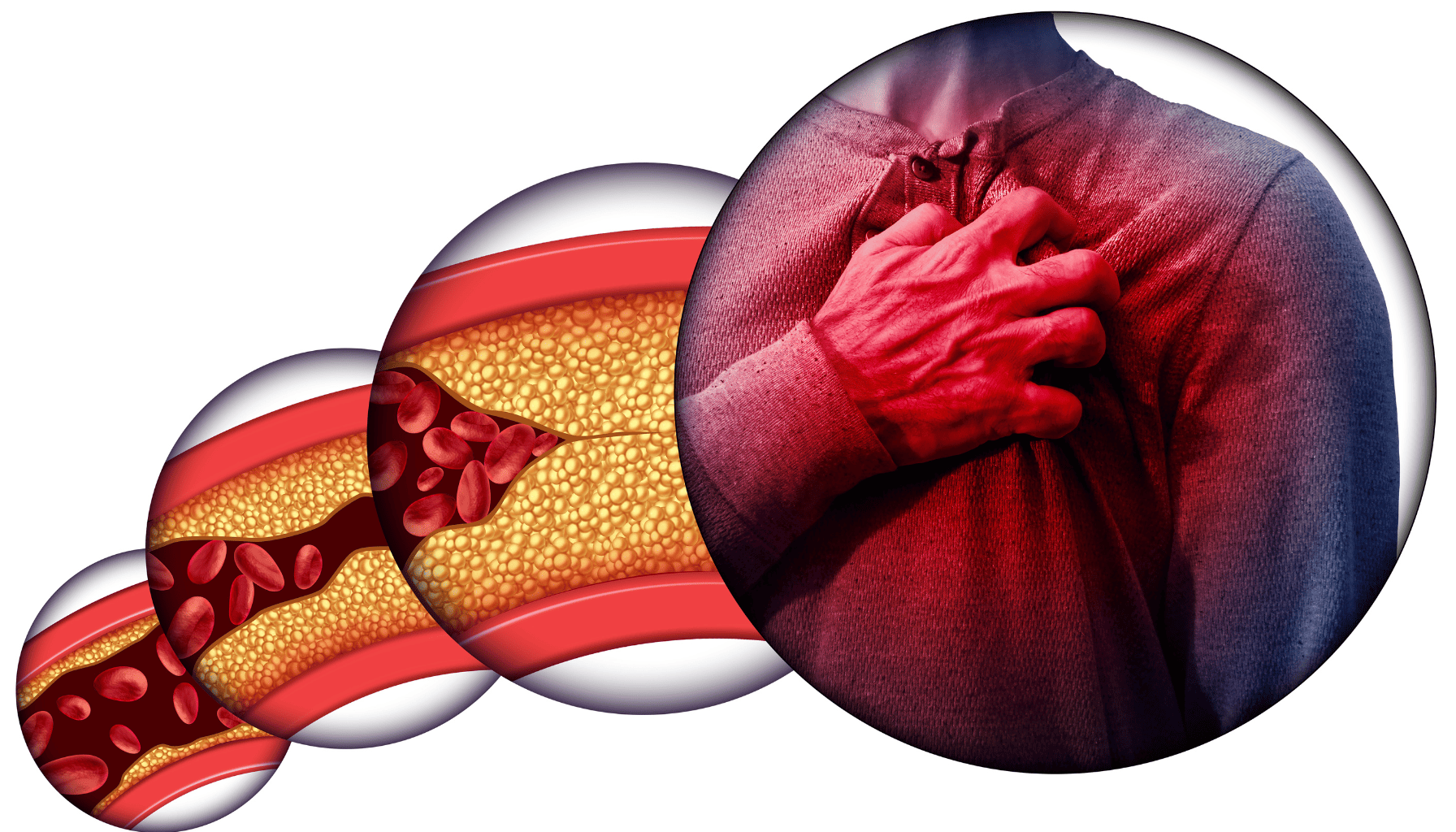 Doença isquêmica do coração: o que é e como afeta a saúde